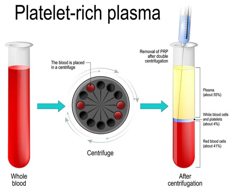 Platelet Rich Plasma Treatment Los Angeles - LA Foot Laser
