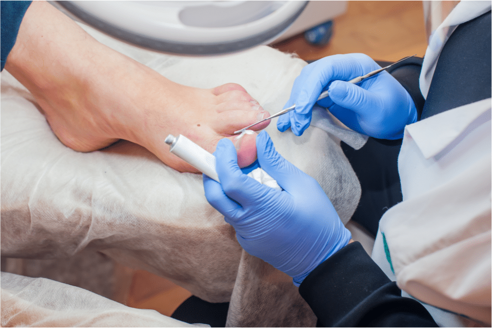 What to Expect: A Step-by-Step Guide to Laser Toenail Fungus Treatment ...