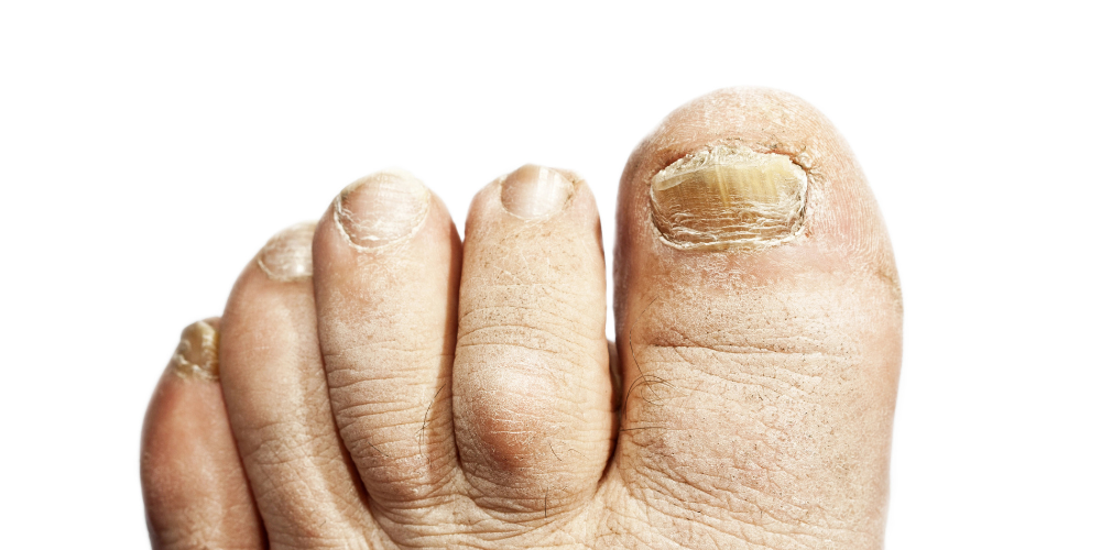 Alien Toe Growths: How Podiatry Care Can Help - LA Foot Laser
