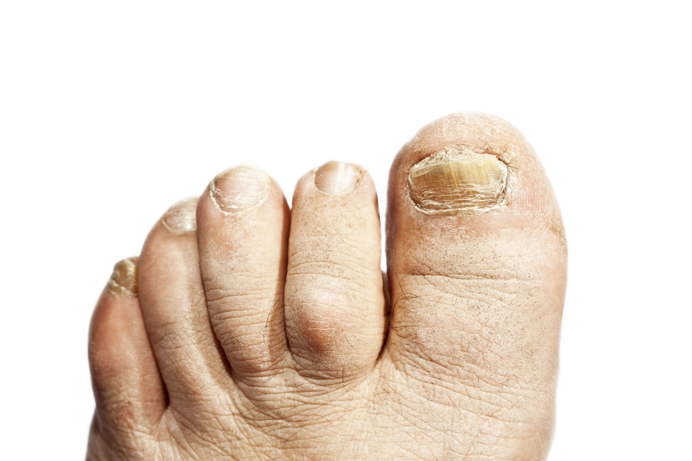 Alien Toe Growths: How Podiatry Care Can Help - LA Foot Laser